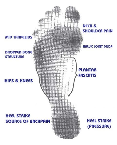 Common Foot Problems | Forward Arch